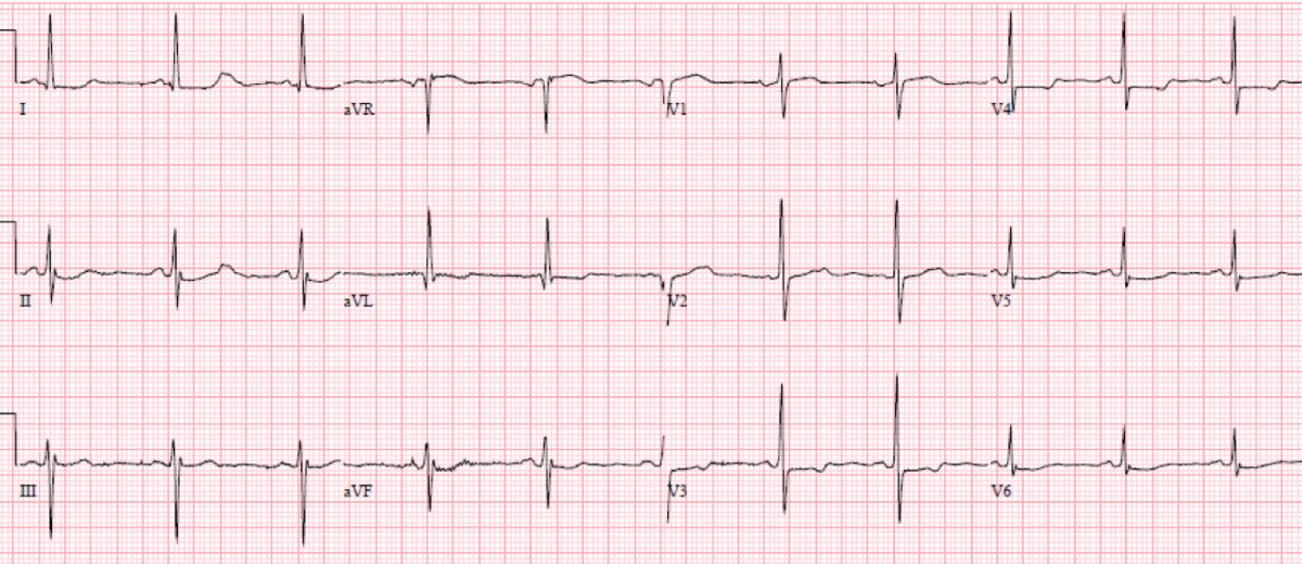 ECG Approach to Atrial Fibrillation | ECG Cases | Emergency Medicine Cases