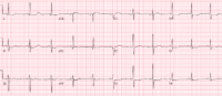ECG Approach to Atrial Fibrillation | ECG Cases | Emergency Medicine Cases
