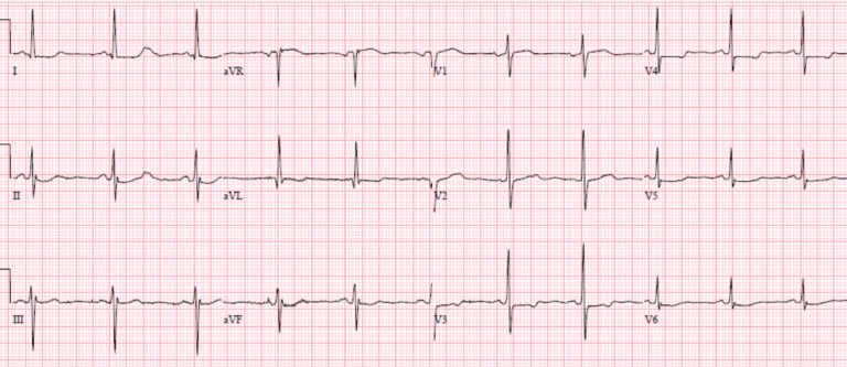 ECG Approach to Atrial Fibrillation | ECG Cases | Emergency Medicine Cases