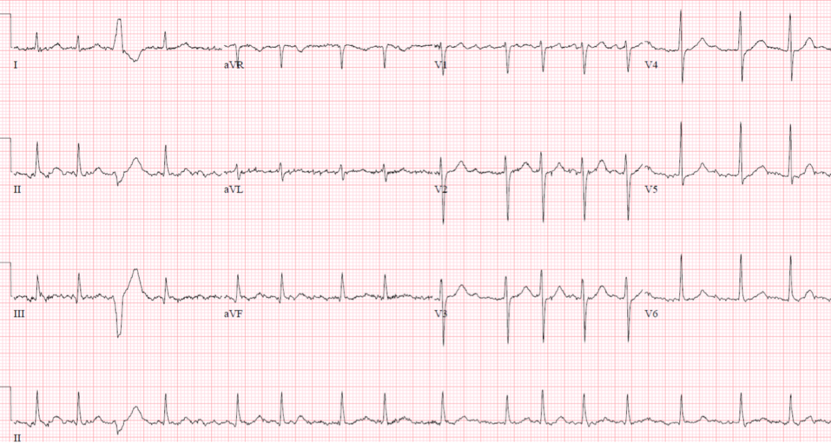 ECG Approach to Atrial Fibrillation | ECG Cases | Emergency Medicine Cases