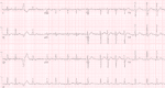 ECG Approach to Atrial Fibrillation | ECG Cases | Emergency Medicine Cases