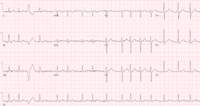 ECG Approach to Atrial Fibrillation | ECG Cases | Emergency Medicine Cases
