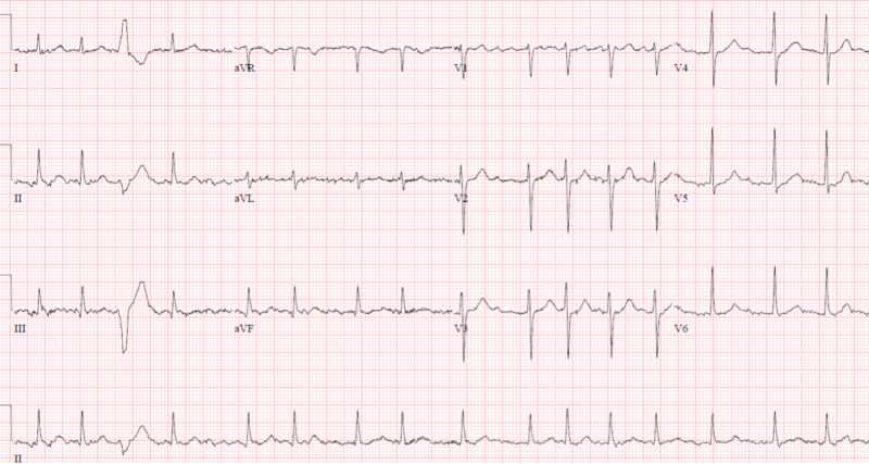 ECG Approach to Atrial Fibrillation | ECG Cases | Emergency Medicine Cases
