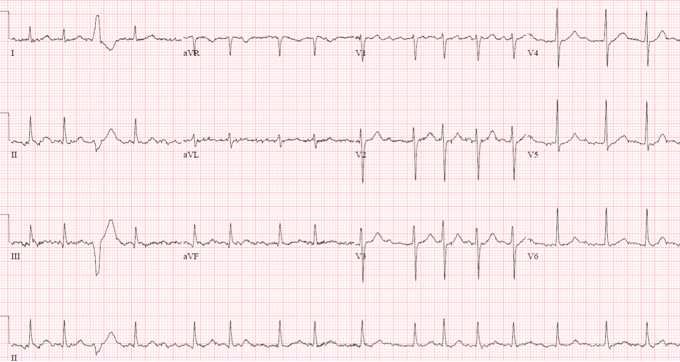 ECG Approach to Atrial Fibrillation | ECG Cases | Emergency Medicine Cases