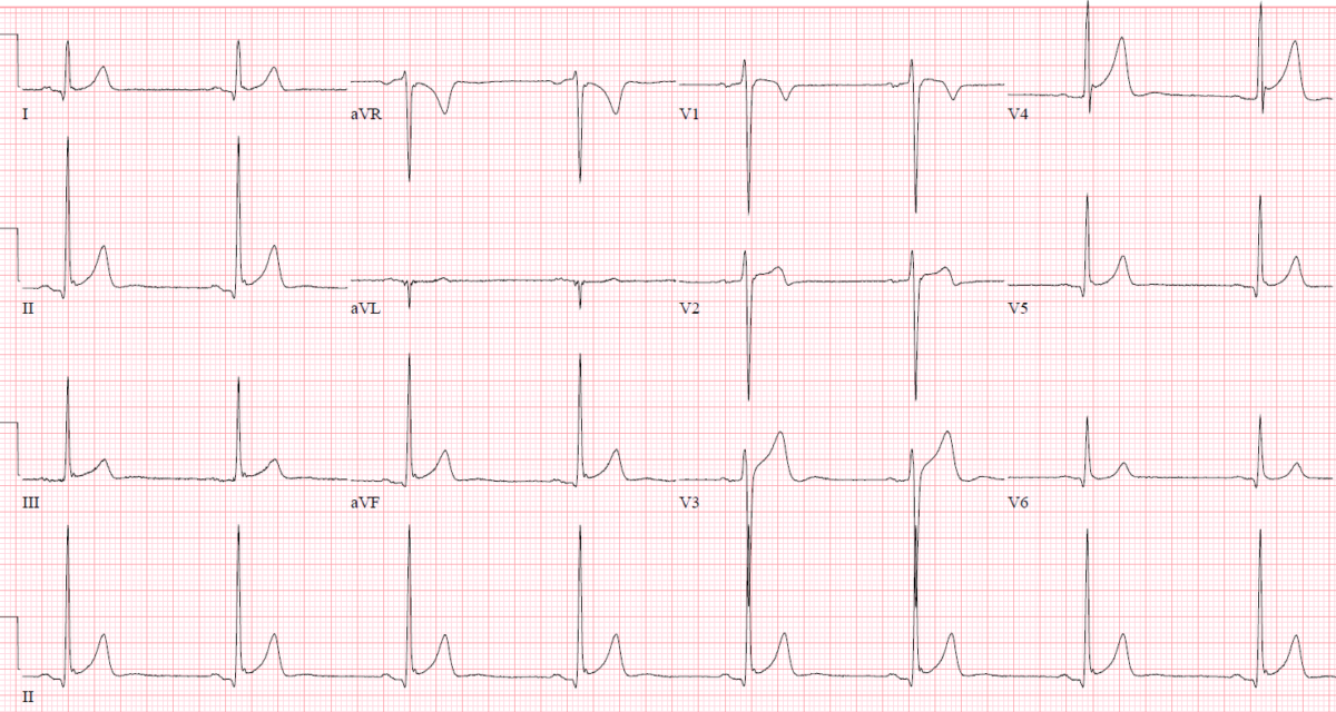 Misdiagnosis from ECG Lead Misplacement, Artifact and Lead Reversal ...