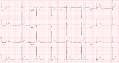 Misdiagnosis from ECG Lead Misplacement, Artifact and Lead Reversal ...