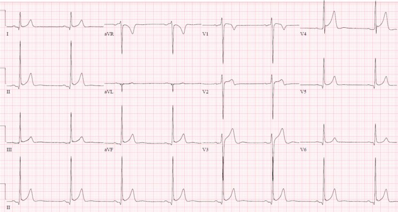 Misdiagnosis from ECG Lead Misplacement, Artifact and Lead Reversal ...