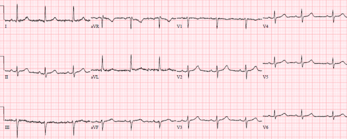 Misdiagnosis from ECG Lead Misplacement, Artifact and Lead Reversal ...