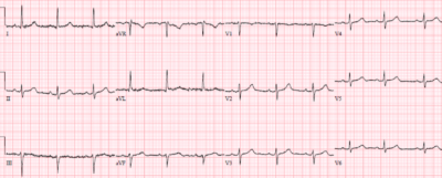 Misdiagnosis from ECG Lead Misplacement, Artifact and Lead Reversal ...