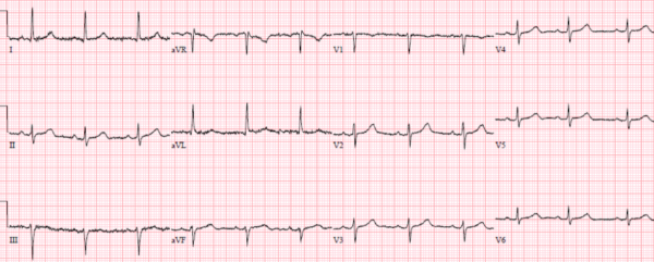 Misdiagnosis from ECG Lead Misplacement, Artifact and Lead Reversal ...