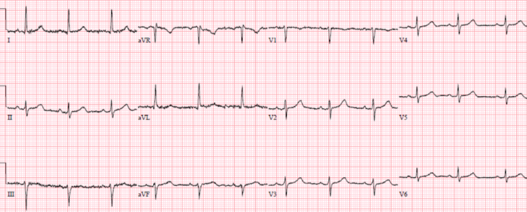 Misdiagnosis from ECG Lead Misplacement, Artifact and Lead Reversal ...