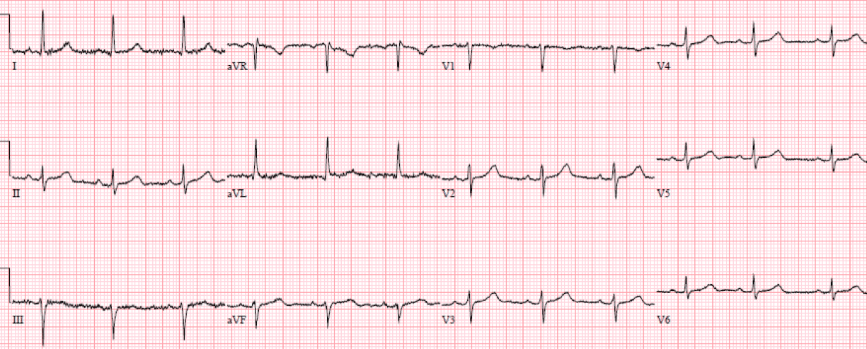 Misdiagnosis from ECG Lead Misplacement, Artifact and Lead Reversal ...