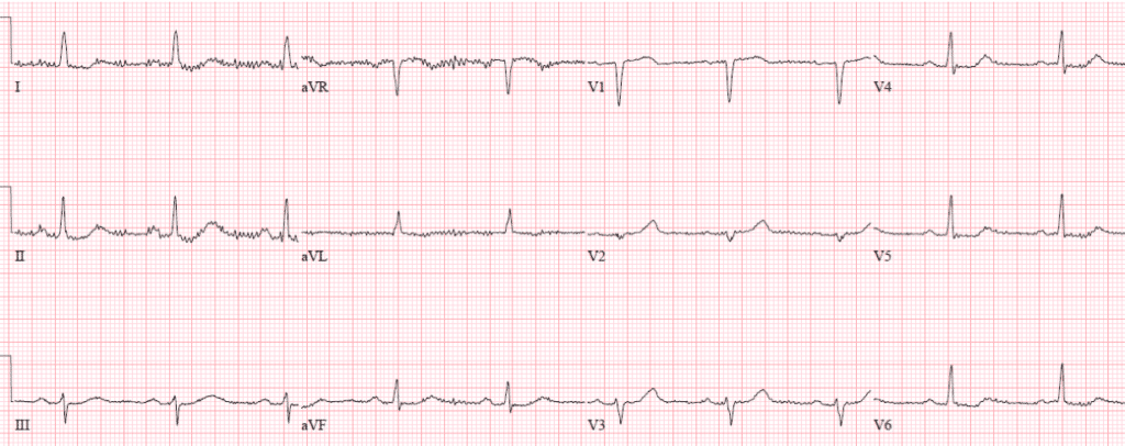 Misdiagnosis from ECG Lead Misplacement, Artifact and Lead Reversal ...