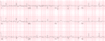 Misdiagnosis from ECG Lead Misplacement, Artifact and Lead Reversal ...