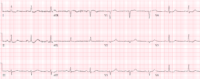 Misdiagnosis from ECG Lead Misplacement, Artifact and Lead Reversal ...