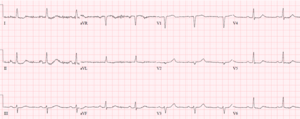 Misdiagnosis from ECG Lead Misplacement, Artifact and Lead Reversal ...