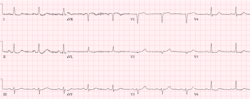 Misdiagnosis from ECG Lead Misplacement, Artifact and Lead Reversal ...