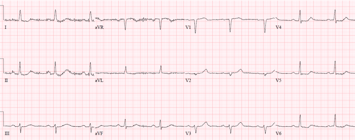 Misdiagnosis from ECG Lead Misplacement, Artifact and Lead Reversal ...