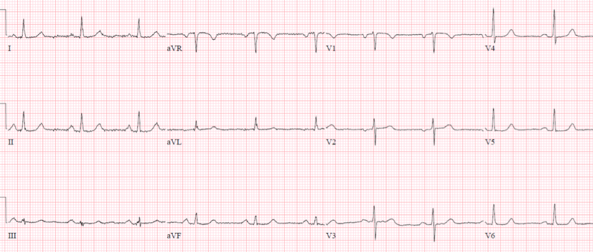 Misdiagnosis from ECG Lead Misplacement, Artifact and Lead Reversal ...