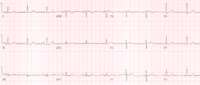 Misdiagnosis from ECG Lead Misplacement, Artifact and Lead Reversal ...