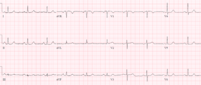 Misdiagnosis from ECG Lead Misplacement, Artifact and Lead Reversal ...