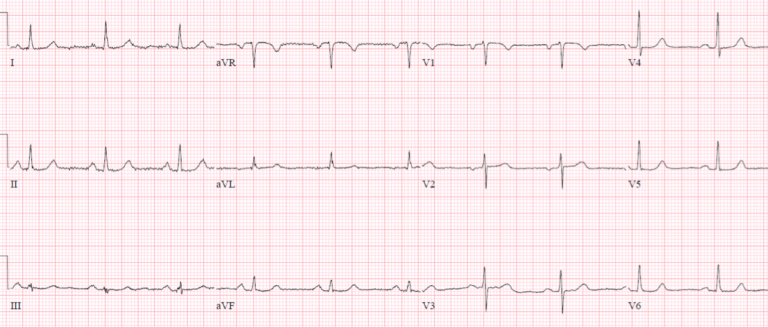 Misdiagnosis from ECG Lead Misplacement, Artifact and Lead Reversal ...