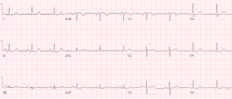 Misdiagnosis from ECG Lead Misplacement, Artifact and Lead Reversal ...