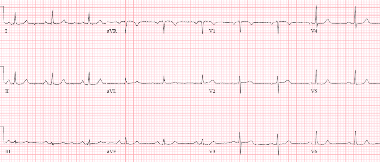 Misdiagnosis from ECG Lead Misplacement, Artifact and Lead Reversal ...