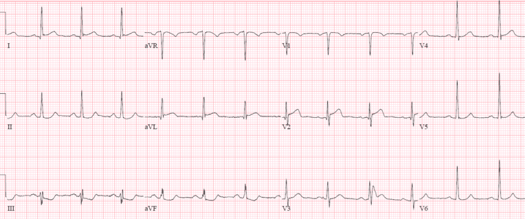 Misdiagnosis from ECG Lead Misplacement, Artifact and Lead Reversal ...