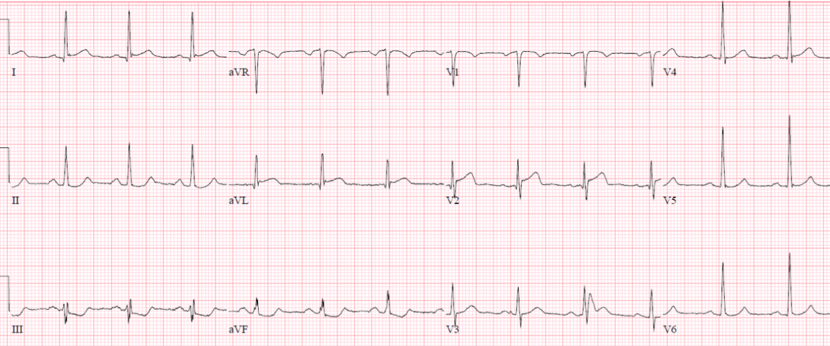 Misdiagnosis from ECG Lead Misplacement, Artifact and Lead Reversal ...