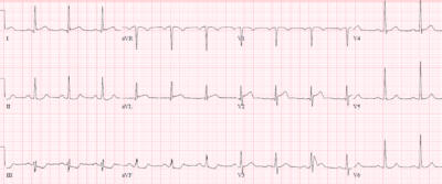 Misdiagnosis from ECG Lead Misplacement, Artifact and Lead Reversal ...