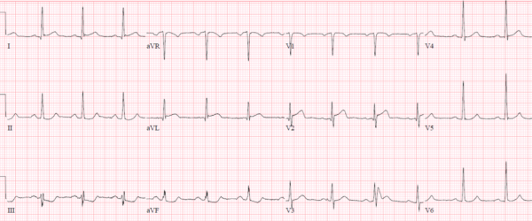 Misdiagnosis from ECG Lead Misplacement, Artifact and Lead Reversal ...