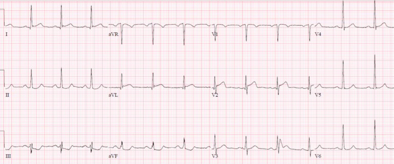 Misdiagnosis from ECG Lead Misplacement, Artifact and Lead Reversal ...