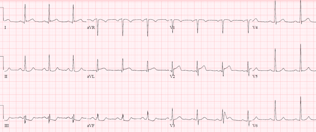Misdiagnosis from ECG Lead Misplacement, Artifact and Lead Reversal ...