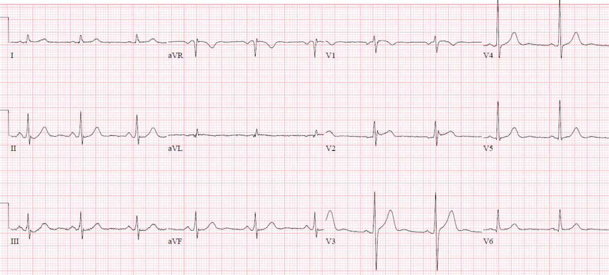 Misdiagnosis from ECG Lead Misplacement, Artifact and Lead Reversal ...