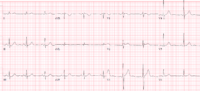 Misdiagnosis from ECG Lead Misplacement, Artifact and Lead Reversal ...