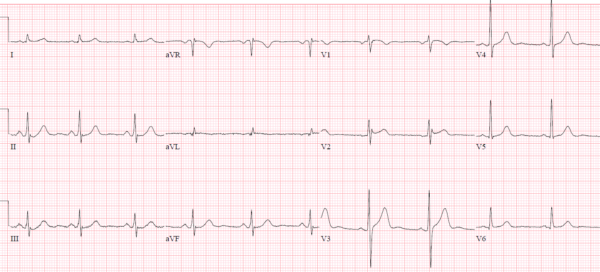 Misdiagnosis from ECG Lead Misplacement, Artifact and Lead Reversal ...
