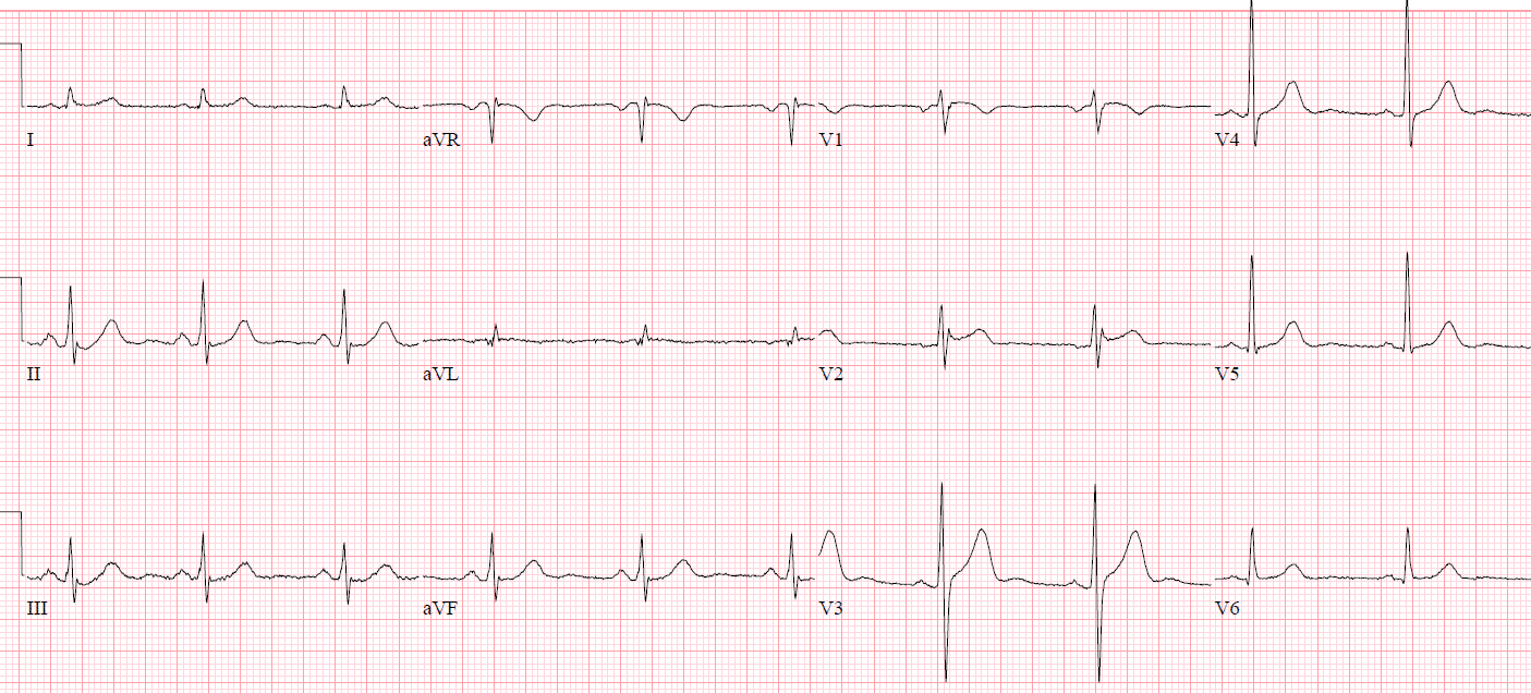 Misdiagnosis from ECG Lead Misplacement, Artifact and Lead Reversal ...