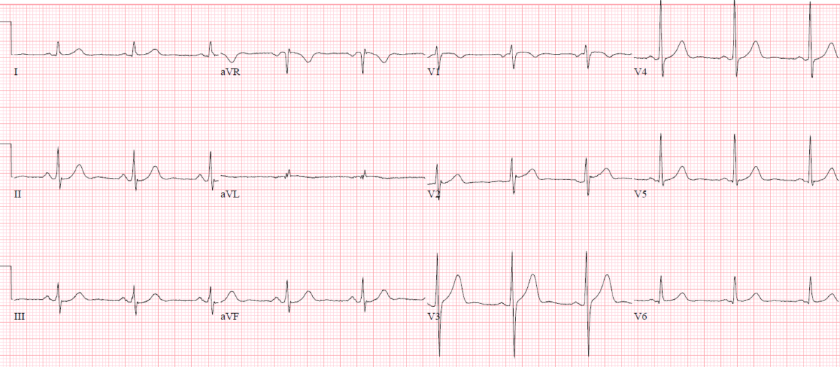 Misdiagnosis from ECG Lead Misplacement, Artifact and Lead Reversal ...
