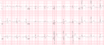 Misdiagnosis from ECG Lead Misplacement, Artifact and Lead Reversal ...