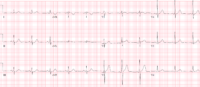 Misdiagnosis from ECG Lead Misplacement, Artifact and Lead Reversal ...