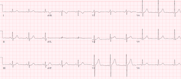 Misdiagnosis from ECG Lead Misplacement, Artifact and Lead Reversal ...