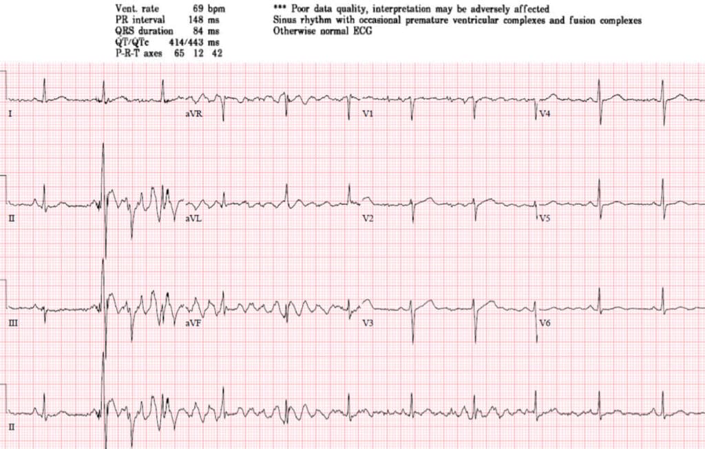 Misdiagnosis from ECG Lead Misplacement, Artifact and Lead Reversal ...