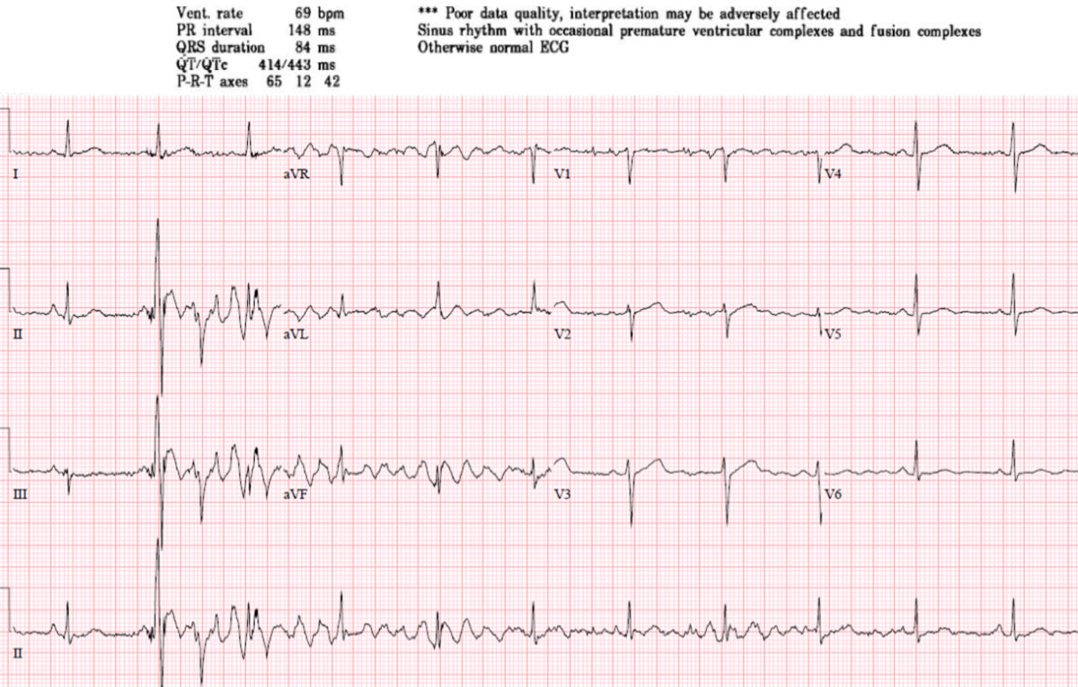Misdiagnosis from ECG Lead Misplacement, Artifact and Lead Reversal ...