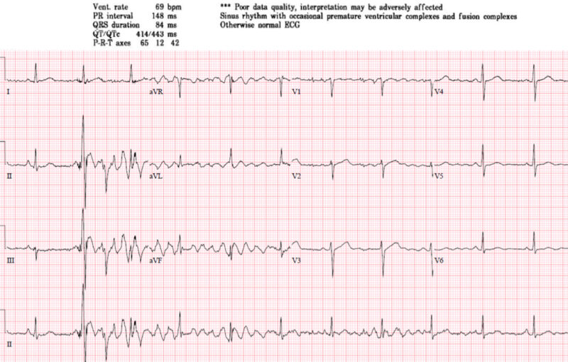 Misdiagnosis from ECG Lead Misplacement, Artifact and Lead Reversal ...