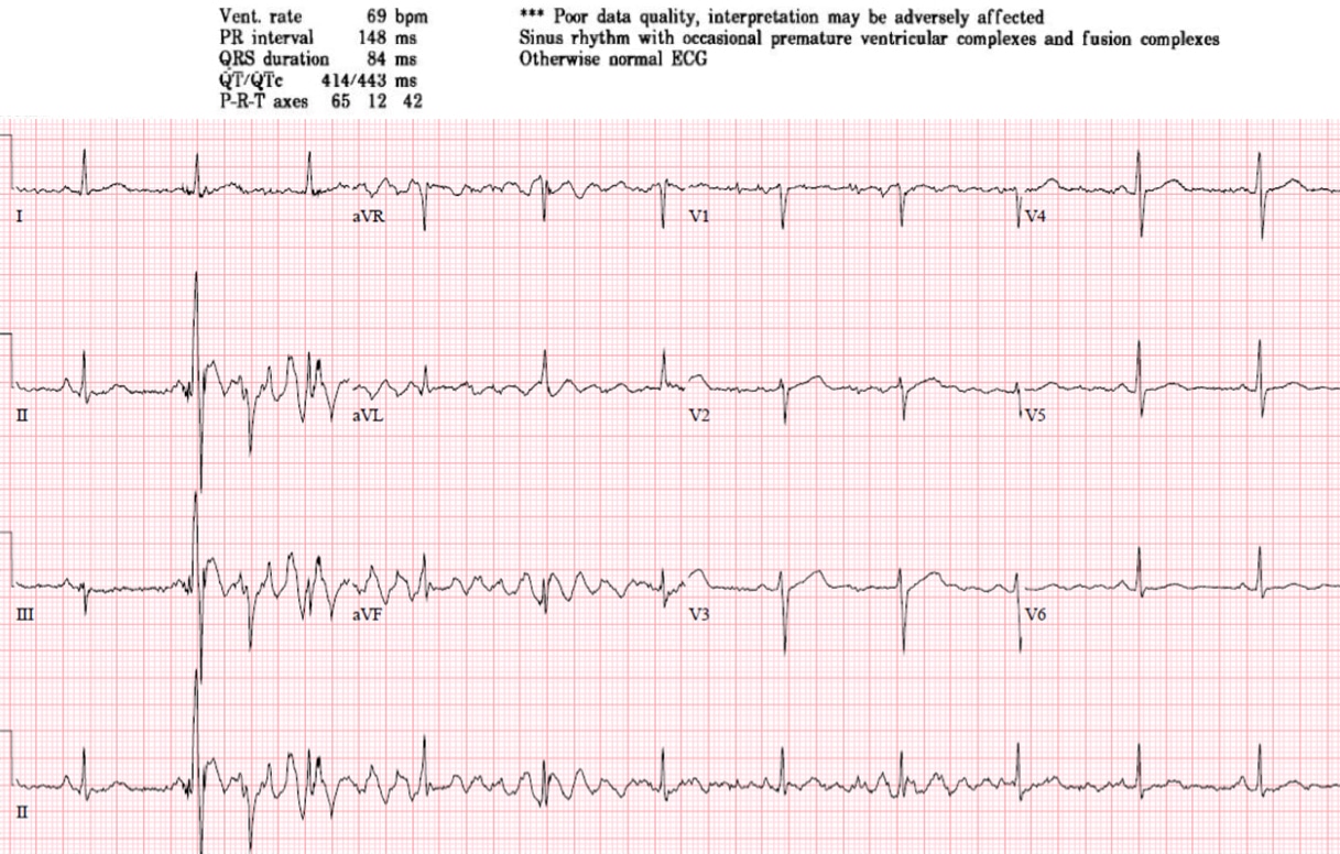 Misdiagnosis from ECG Lead Misplacement, Artifact and Lead Reversal ...