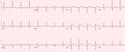 Misdiagnosis from ECG Lead Misplacement, Artifact and Lead Reversal ...