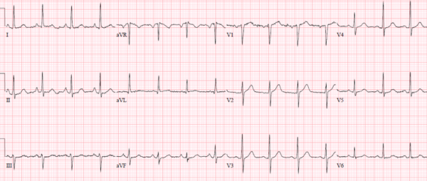 Misdiagnosis from ECG Lead Misplacement, Artifact and Lead Reversal ...