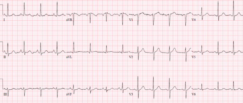 Misdiagnosis from ECG Lead Misplacement, Artifact and Lead Reversal ...