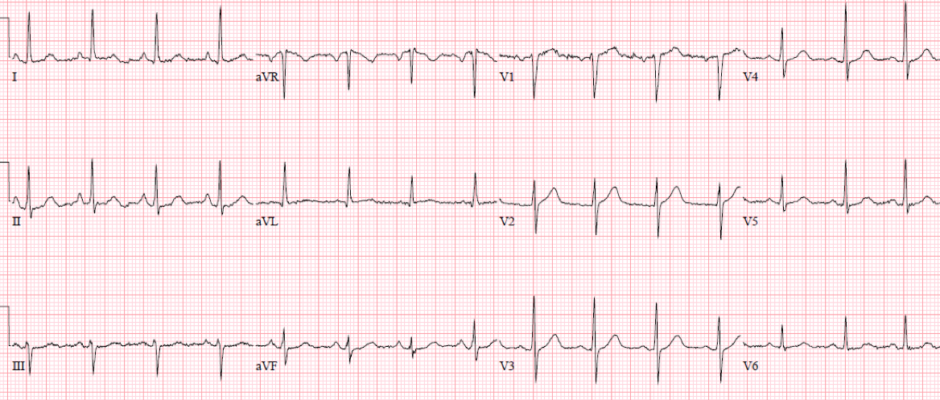 Misdiagnosis from ECG Lead Misplacement, Artifact and Lead Reversal ...